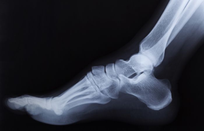 CT Ankle Scan for Fractures & Injuries | Diagnopein