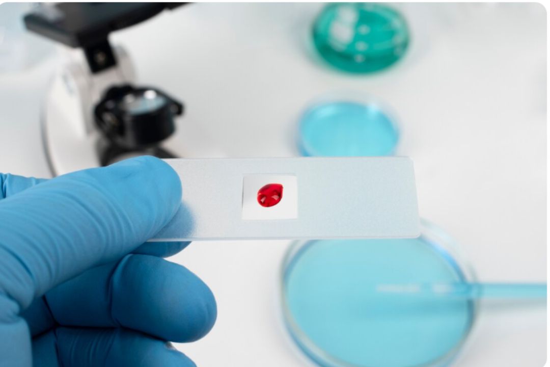 When Should You Take a Bilirubin Test Signs of Liver Damage Cost ...