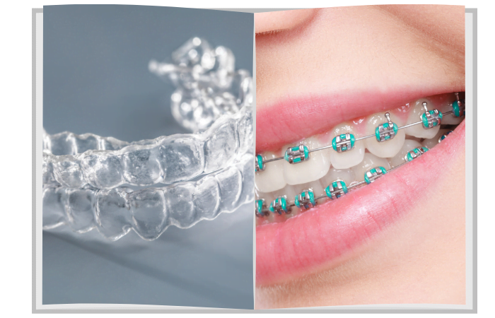 Braces vs. Aligners: Expert Advice from Diagnopein Dental Care