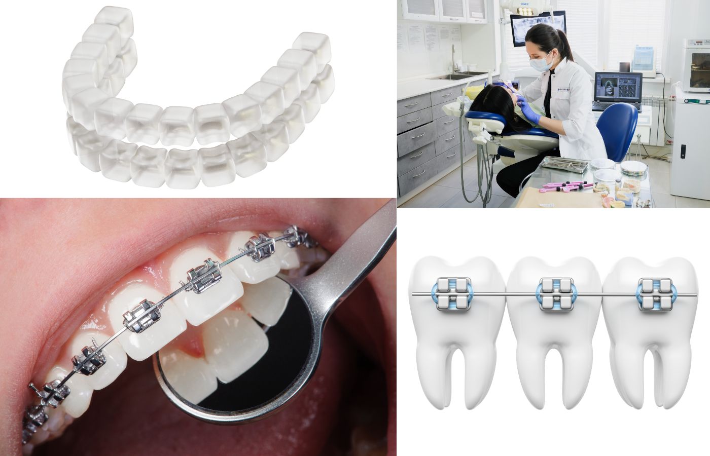 Braces vs. Aligners: Best Adult Smile Option Guide