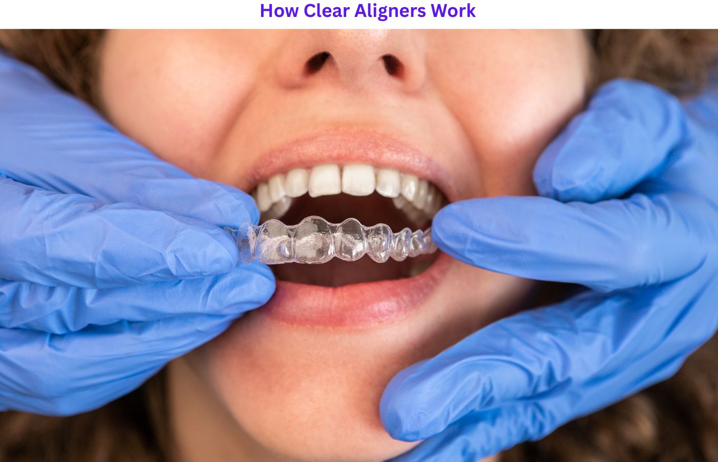 How Clear Aligners Work: A Simple Step-by-Step Guide