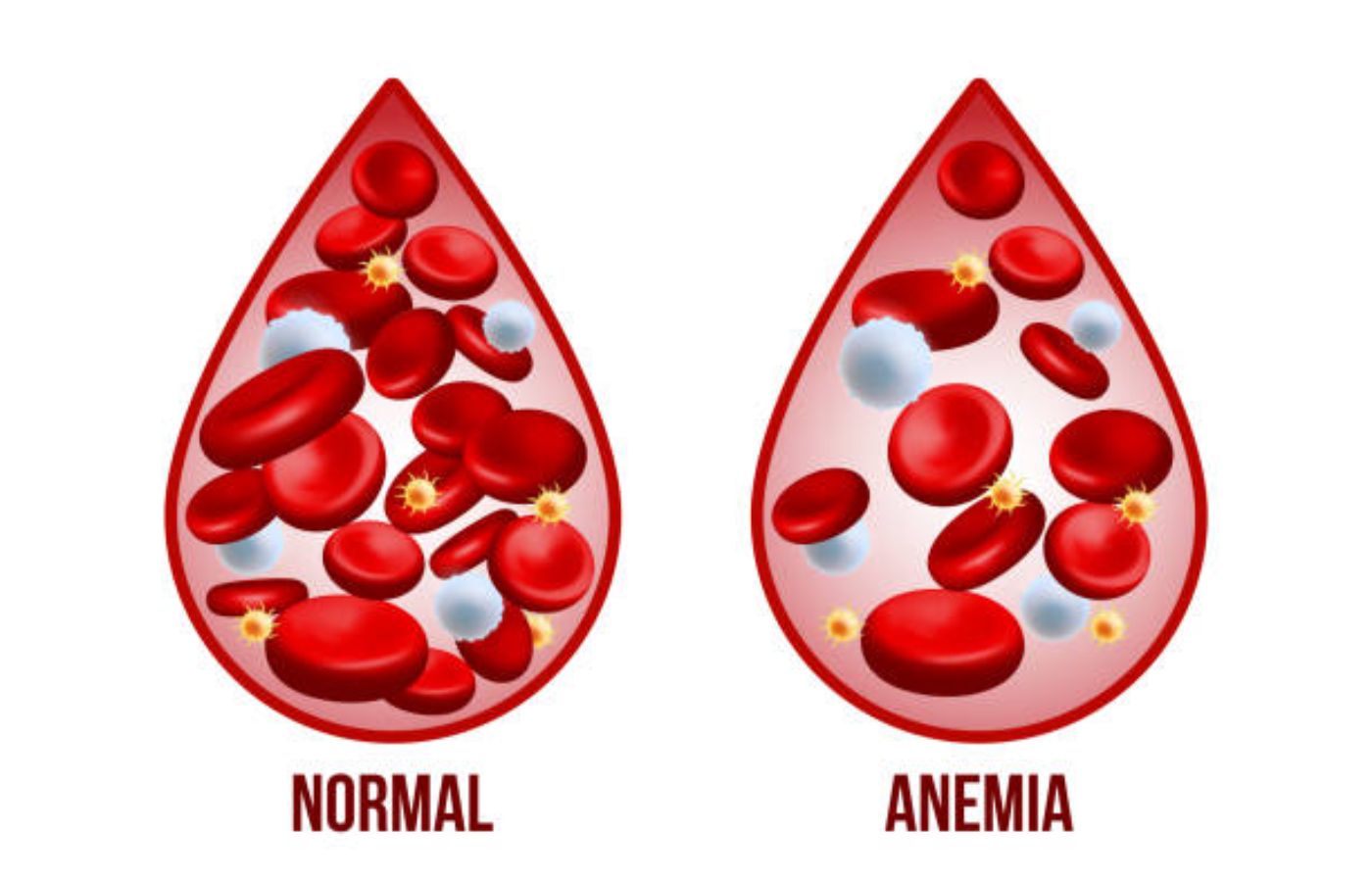 Common Symptoms, Causes & Diagnosis of Anemia | Diagnopein Center