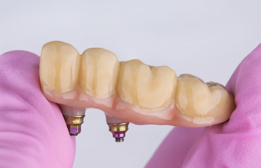Dental Bridges: Cost, Treatment & Benefits | Replace Missing Teeth at ...