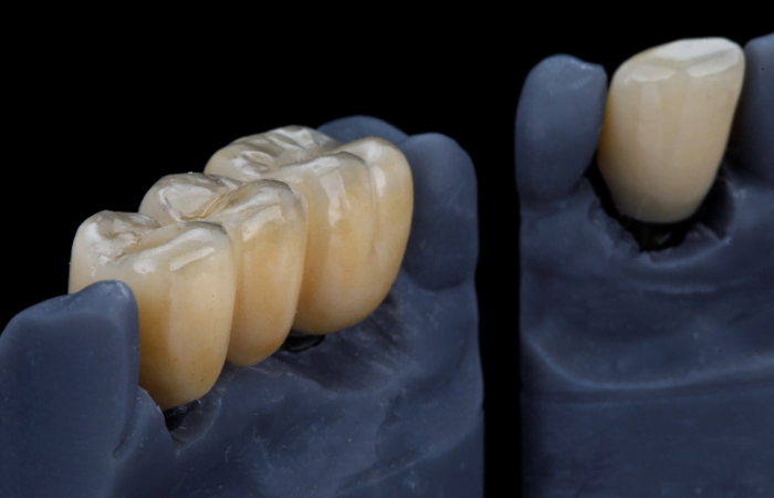 Dental Bridge Preparation Step by Step Guide | Diagnopein