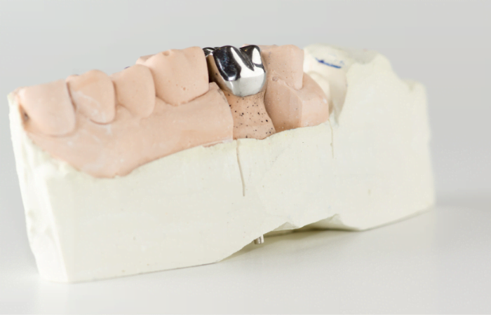 Caring for Your Dental Crown: Best Maintenance Tips