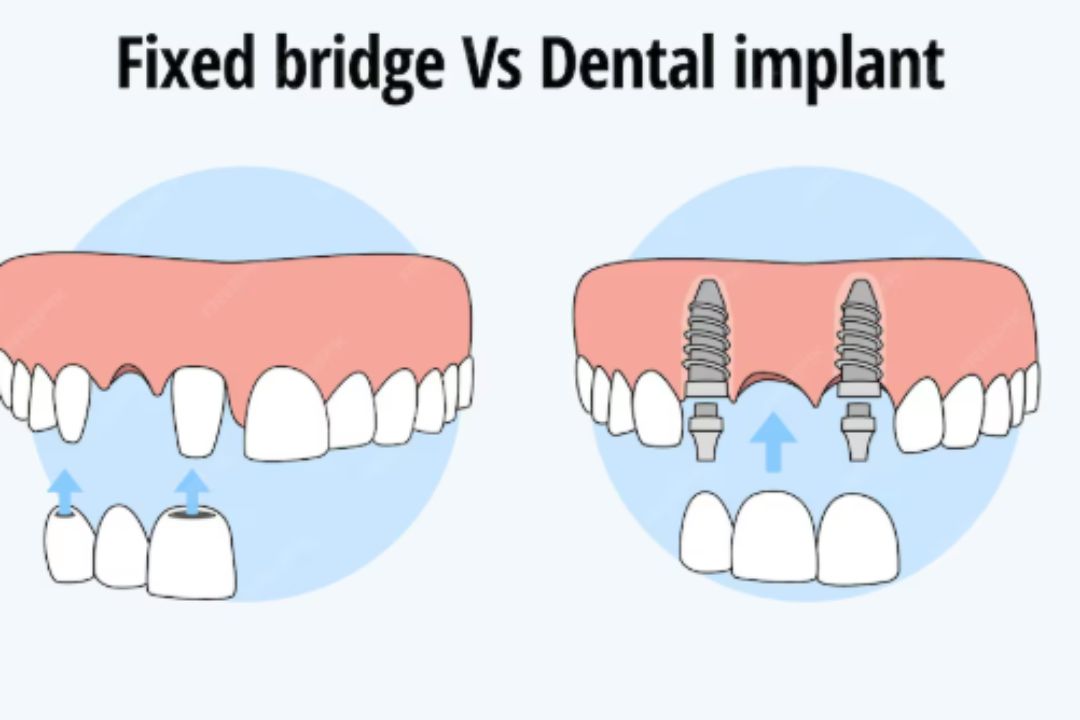 Choosing Between Dental Implant and Bridge Cost, Benefits