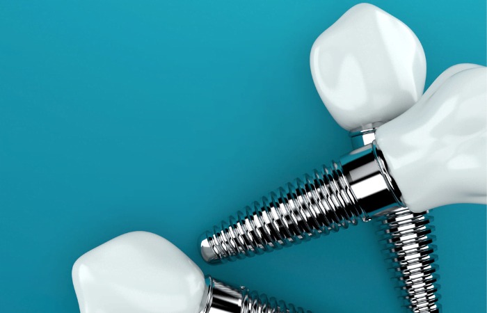 Dental Implants Over Dentures and Bridges | Diagnopen