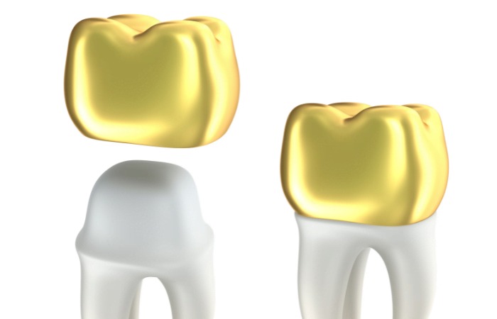 Dental Crowns Enhance Your Smile and Boost Confidence | Diagnopein