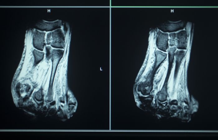 MRI vs. X-ray: Better for Diagnosing Foot Injuries | Diagnopein
