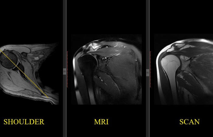MRI Shoulder Scan: Key for Diagnosing Pain & Injuries | Diagnopein