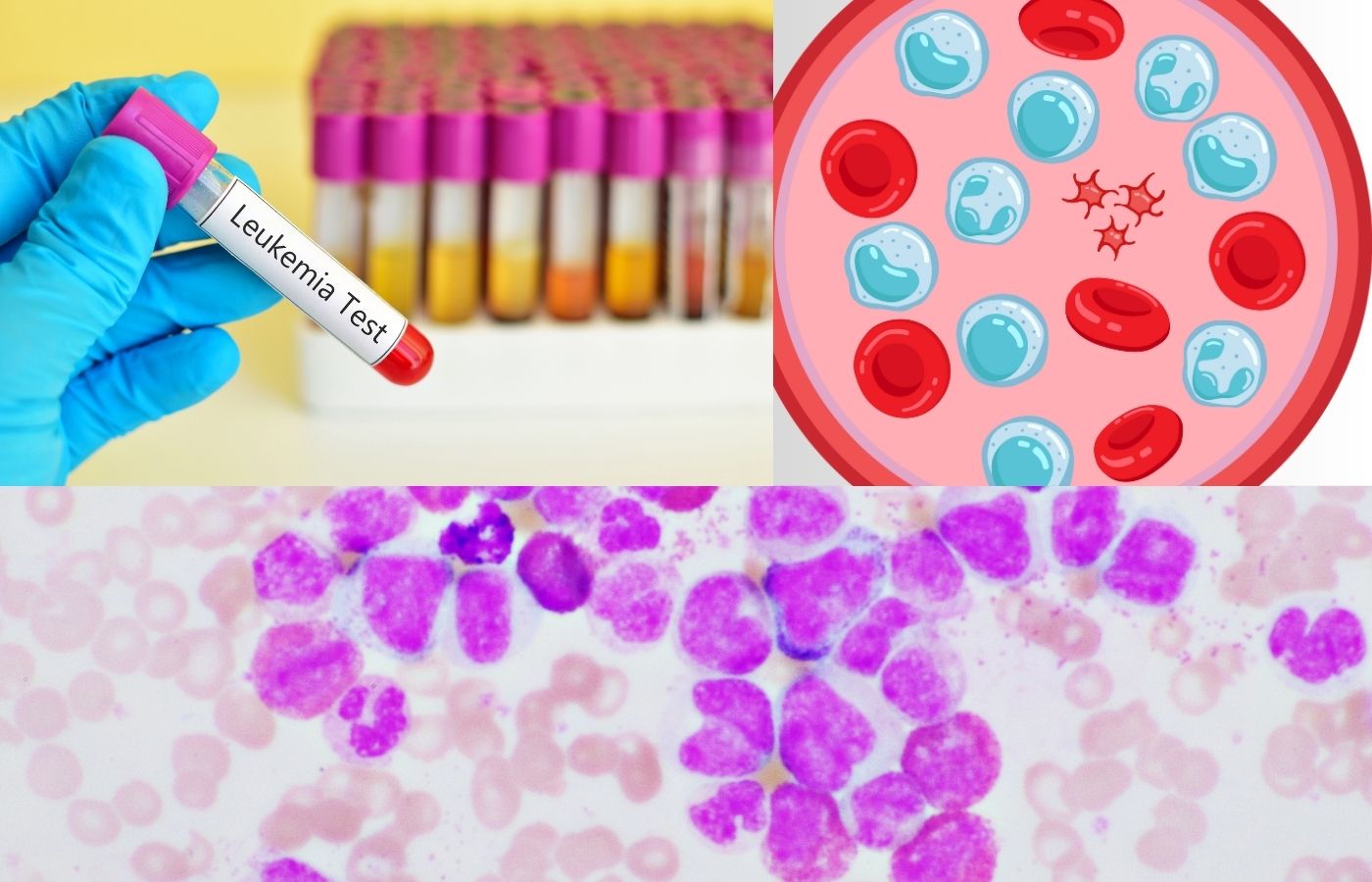 What Is Leukemia? Diagnosis, Symptoms & Blood Tests
