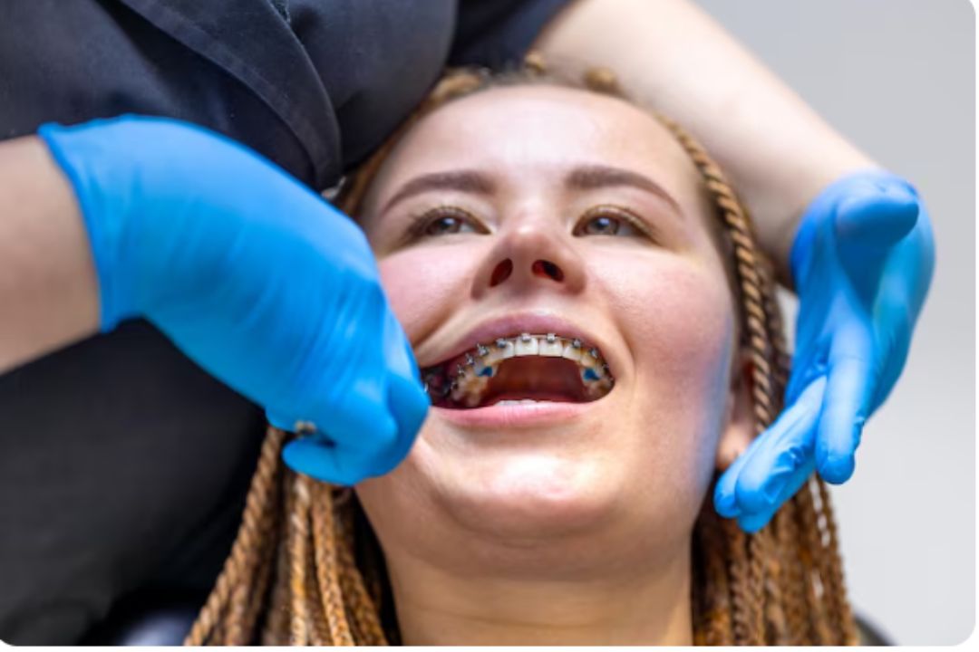 Do Braces Change Your Face Shape? Myths vs. Facts | Diagnopein