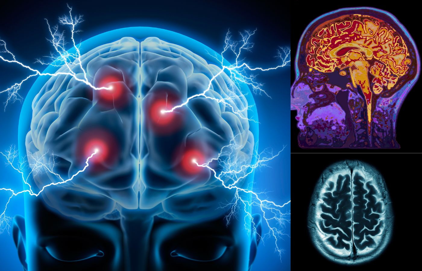 MRI Brain Epilepsy Protocol to Detect Seizure Causes