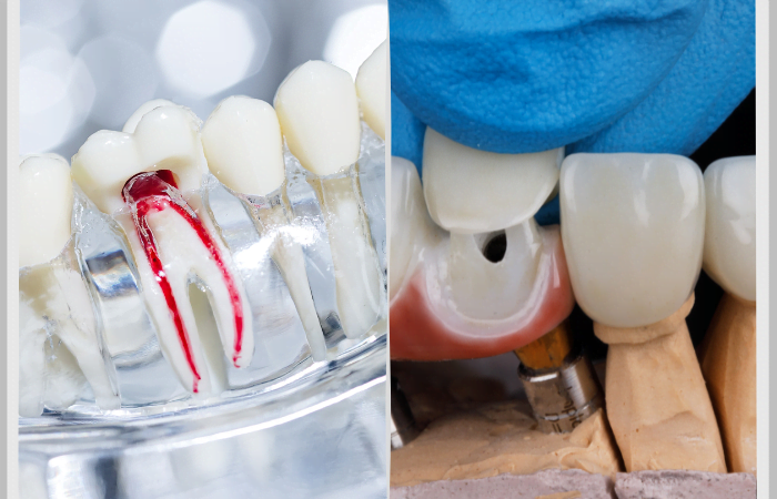 Root Canal Symptoms & Treatment | Diagnopein Dental Clinic
