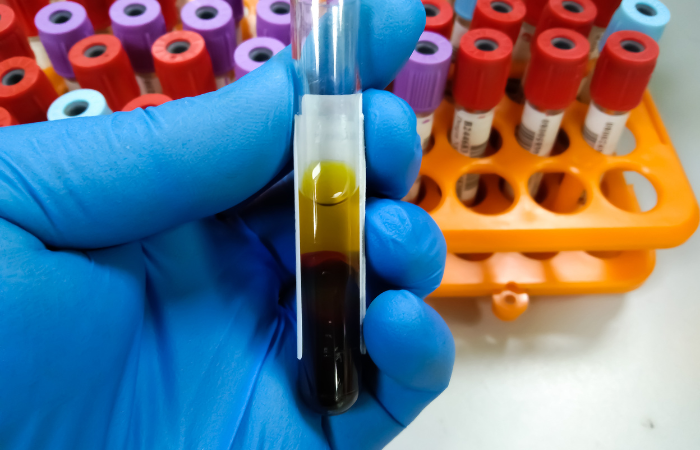Dos and Don’ts For Blood Test | Diagnopein