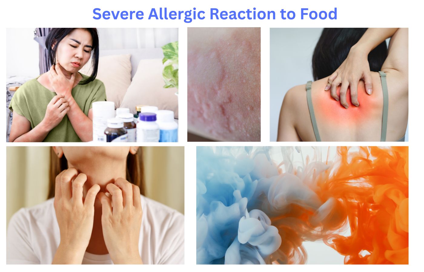 Severe Allergic Reaction to Food – What to Do?