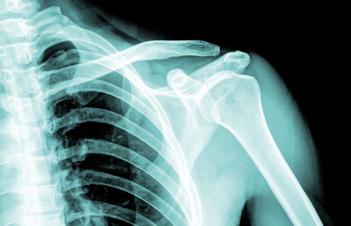 Preparing for a Shoulder X-ray | Diagnopein
