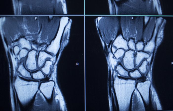 Single-Hand MRI Diagnose Hand Injuries | Diagnopein