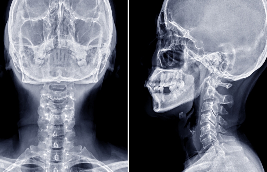 Digital Skull X-Rays Diagnose Head | Diagnopein