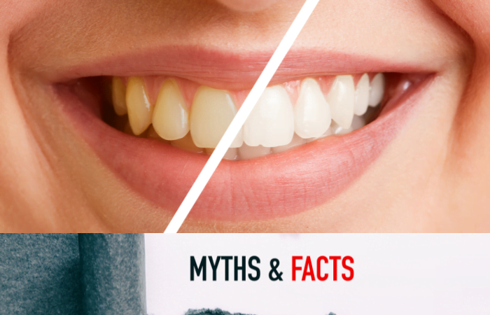 Can Cleaning Damage My Teeth? Myths & Facts Explained.