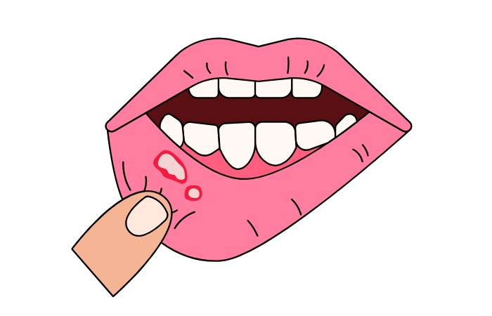 Mouth Ulcers: Prevention & Treatment Tips | Diagnopein