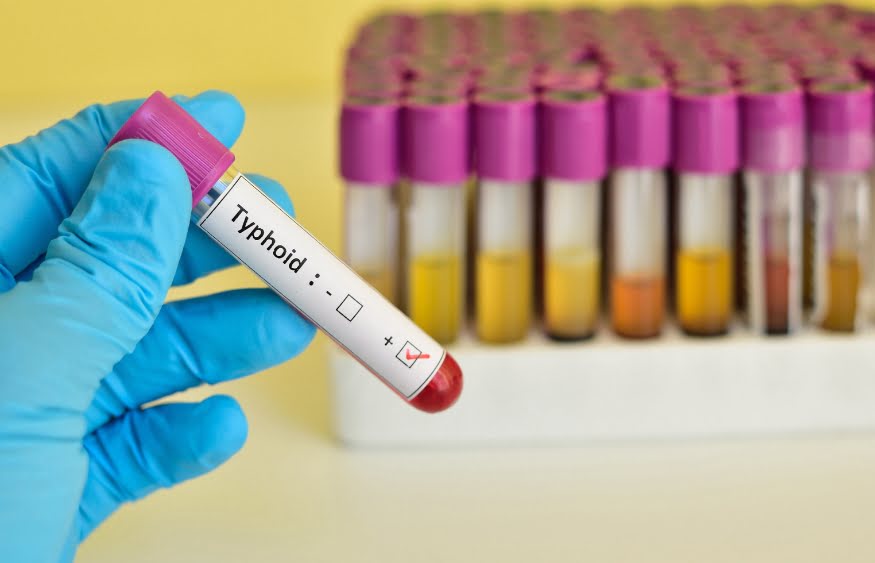 Tips for Prevent Typhoid | Diagnopein