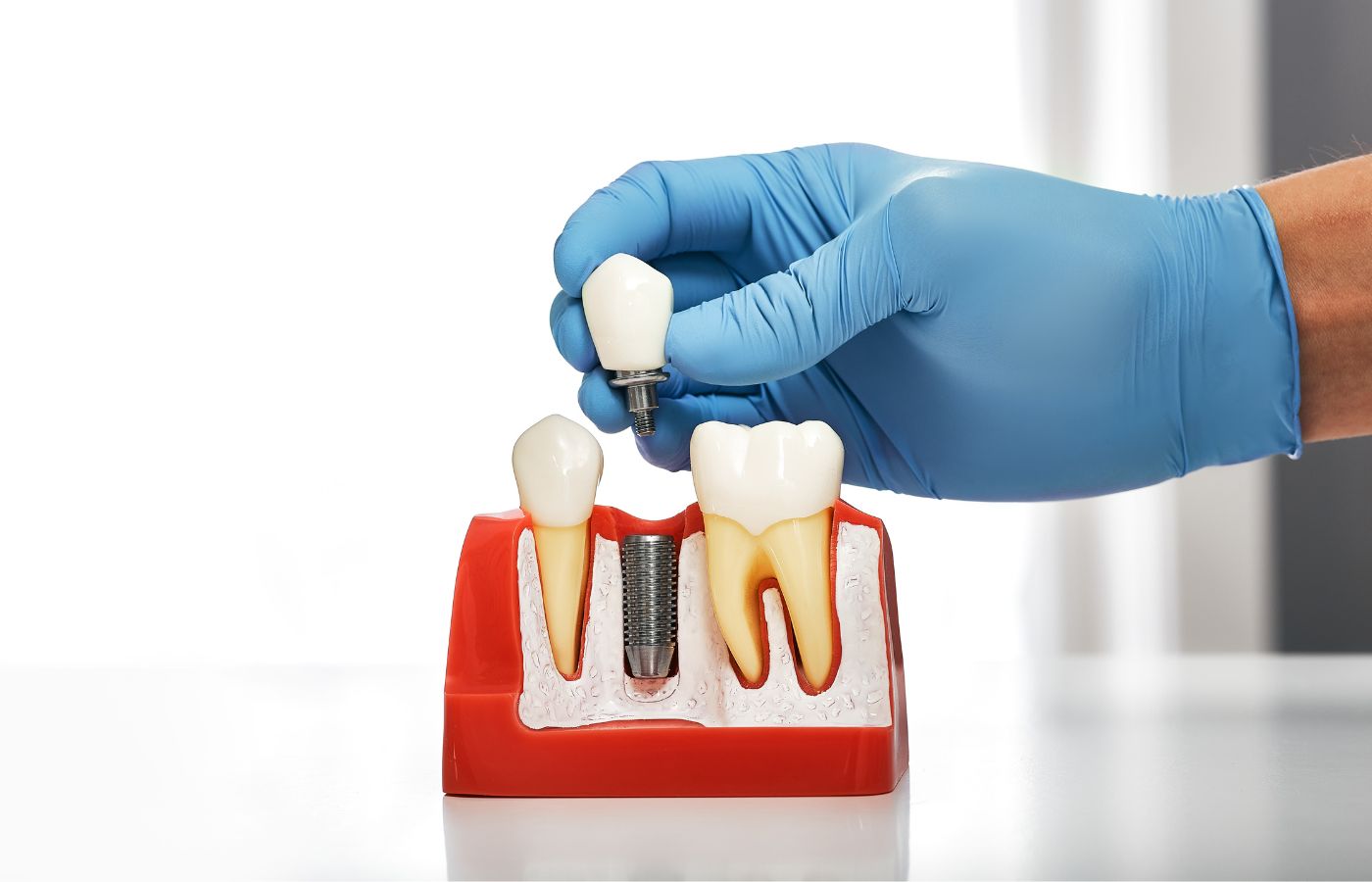 Dental Implants with Pre-existing Conditions: Safe Options | Diagnopein