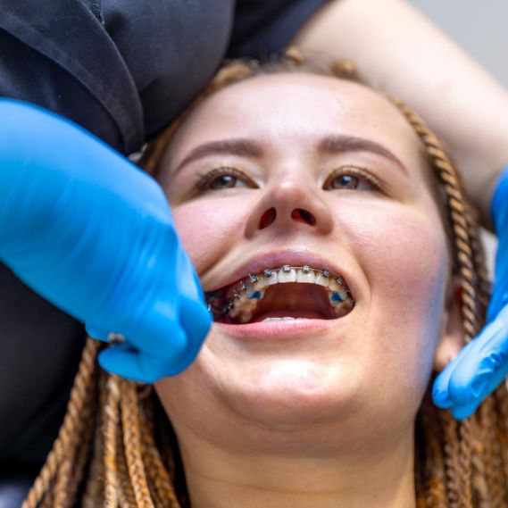 dental braces: preparation, cost, types and why choose diagnopein for ...