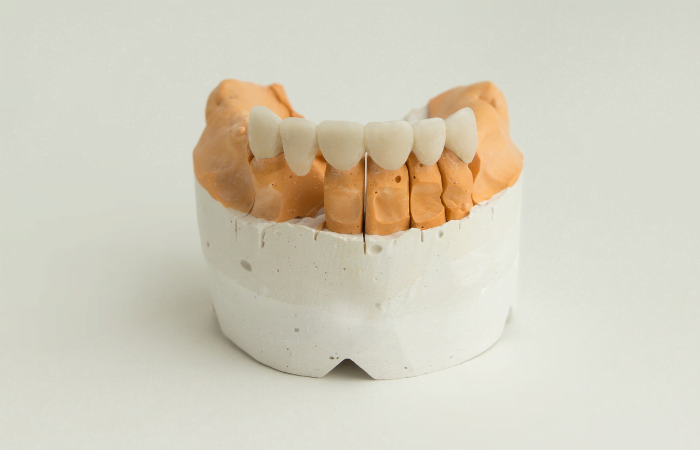 Affordable Dental Crowns Restore Your Smile at Diagnopein