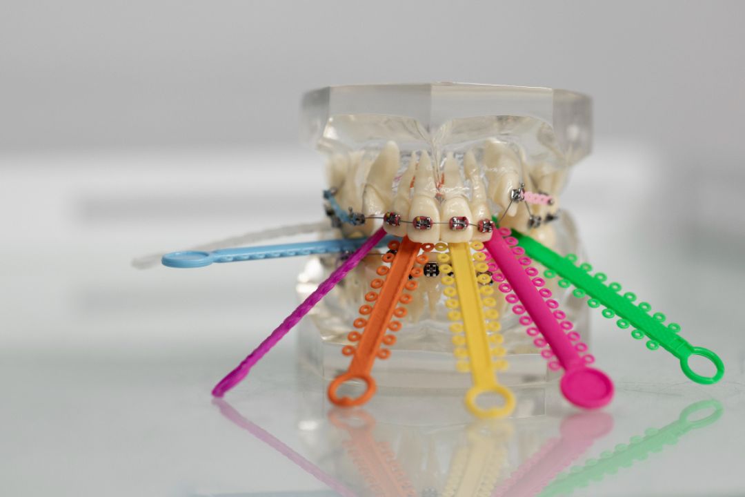 Affordable Metal Braces Price Ranges, Costs and Treatment Guide