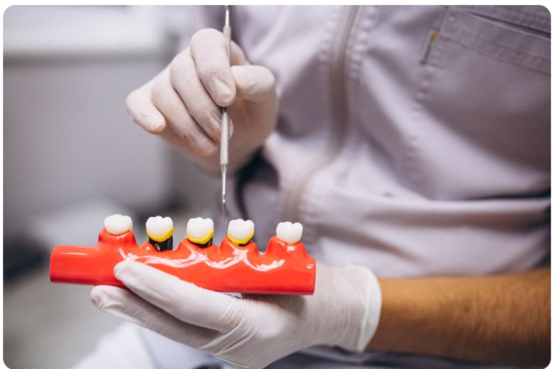All Teeth Implant Cost in India Full Mouth Implants Guide Diagnopein