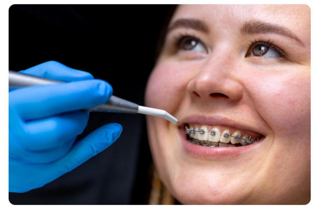 Do Braces Change Your Face Shape? Myths vs. Facts | Diagnopein