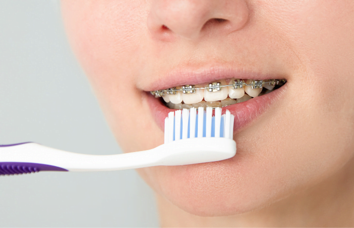 Do Braces Change Your Face Shape Myths vs Facts | Diagnopein