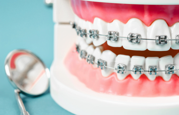 Dental Braces: Types, Procedure & Benefits | Diagnopein