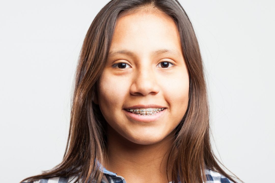 Do Braces Change Your Face Shape? Myths vs. Facts | Diagnopein