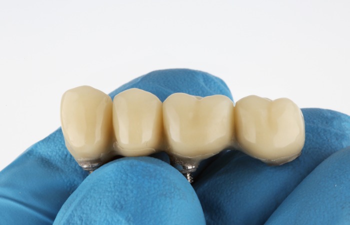 Solution for Missing Teeth and Restoring Your Smile | Diagnopein