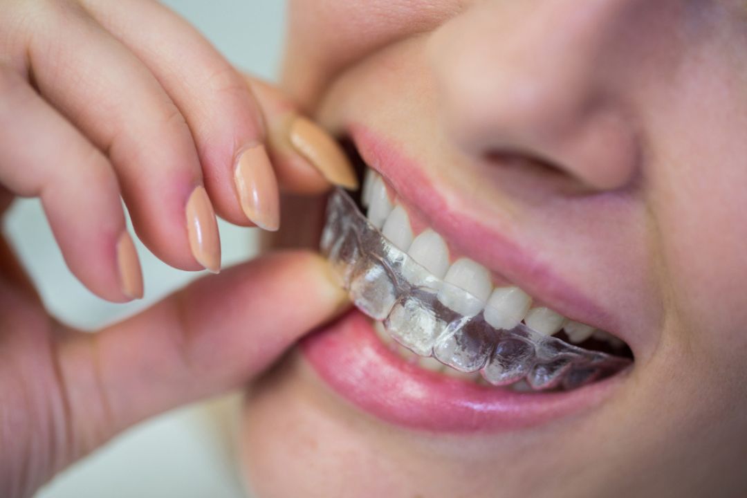 Clear Dental Aligners Guide 2024 | Benefits, Cost & Diagnopein Advice