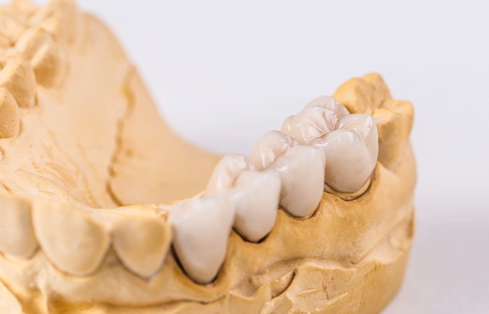 Affordable Dental Crowns for a Smile Makeover | Diagnopein