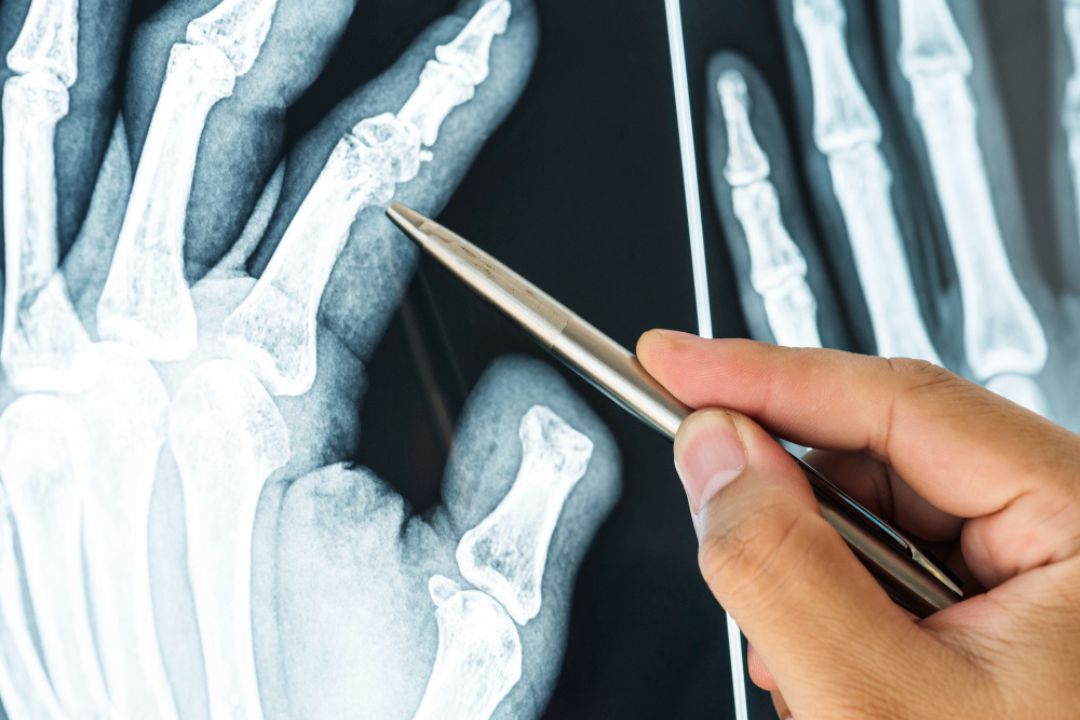Digital Hand X-Rays: Accurate Fracture & Joint Diagnosis | Benefits & Cost