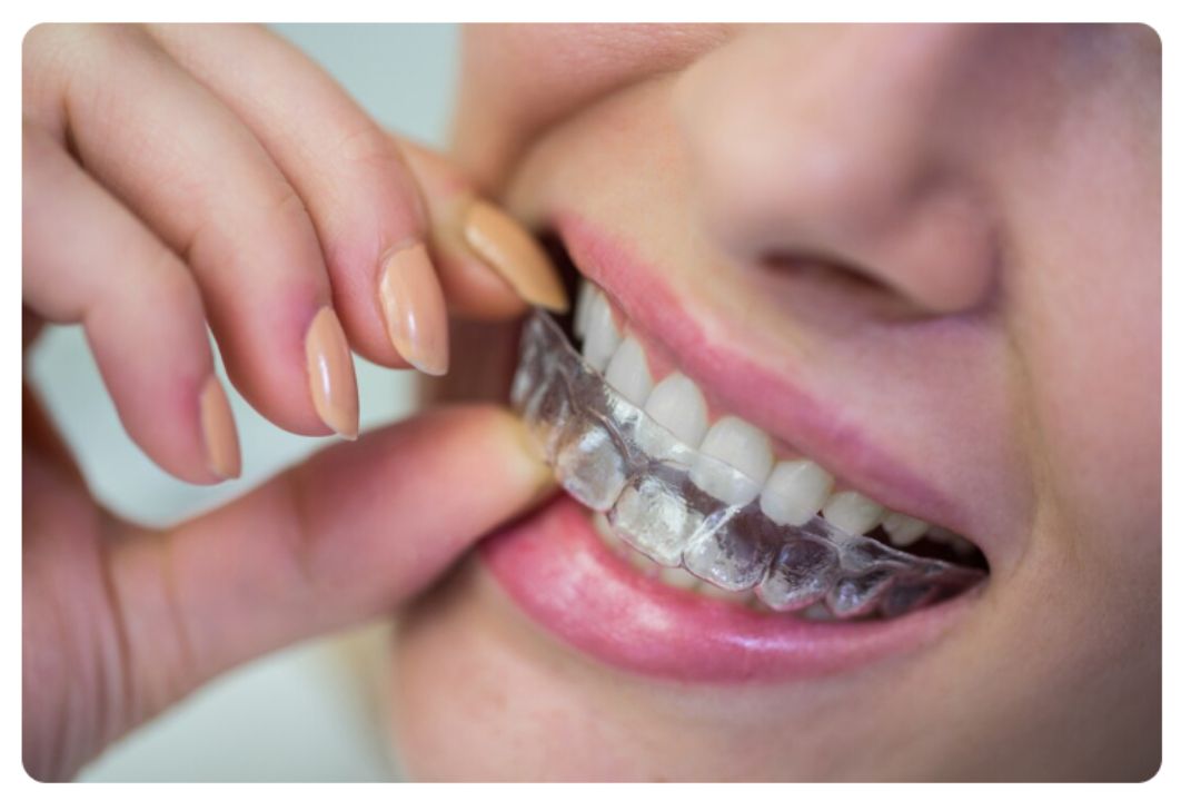 How Clear Aligners Transformed My Smile Aligners Journey & Benefits ...