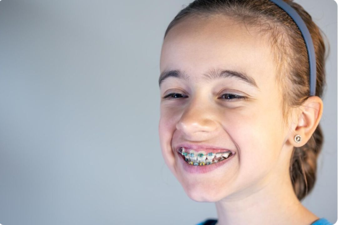 How Long Do Braces Take to Straighten Teeth Complete Guide