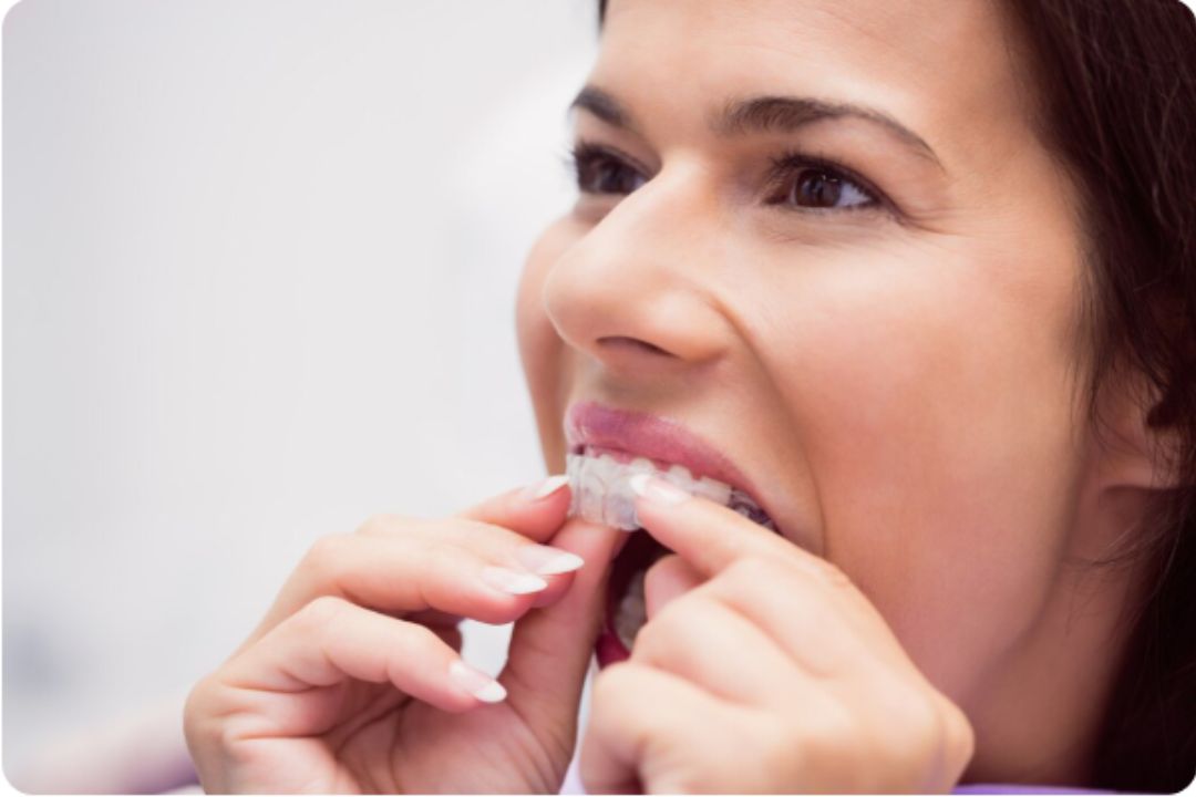 Invisalign Aligner Care Guide: Tips and Benefits | Diagnopein