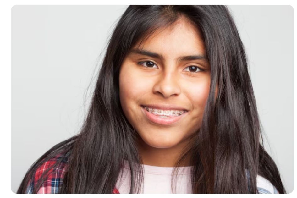 Do Braces Change Your Face Shape? Myths vs. Facts | Diagnopein