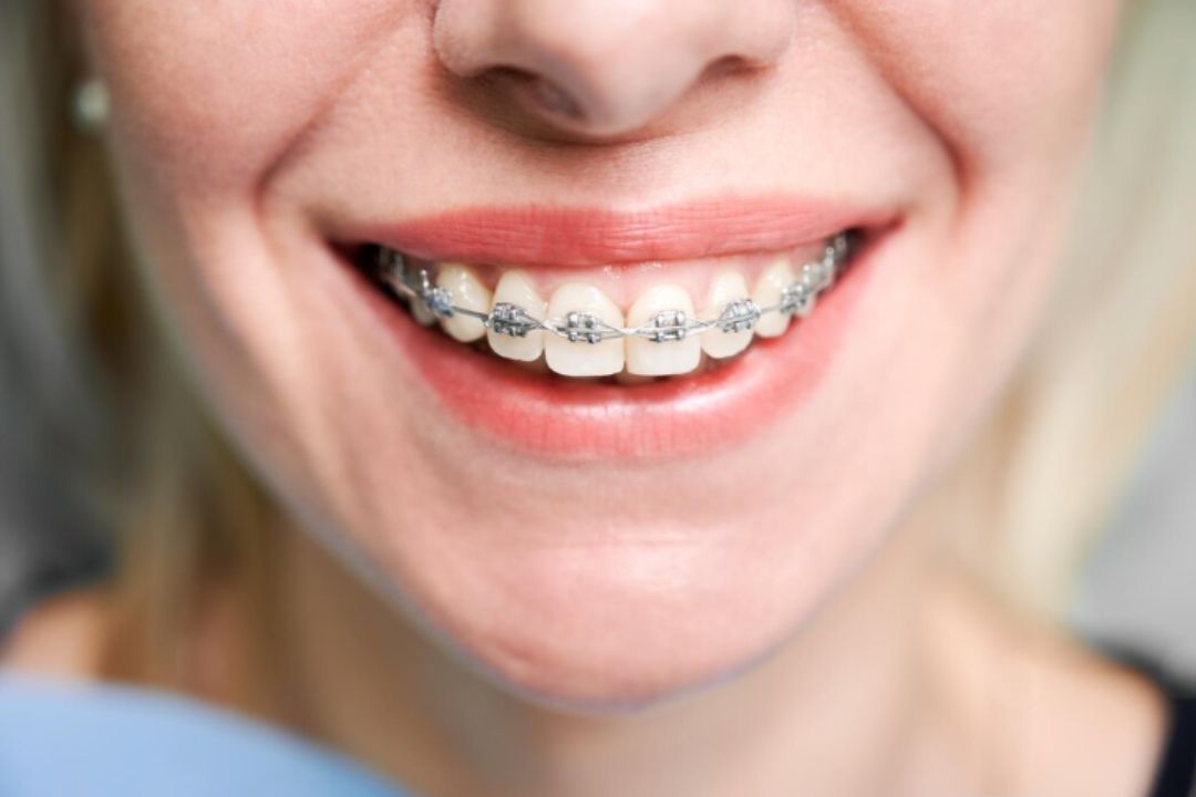 Do Braces Change Your Face Shape? Myths vs. Facts | Diagnopein