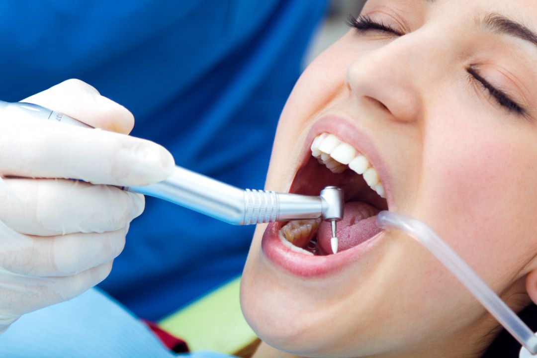 Why Dental Clinics Recommend Professional Teeth Cleaning
