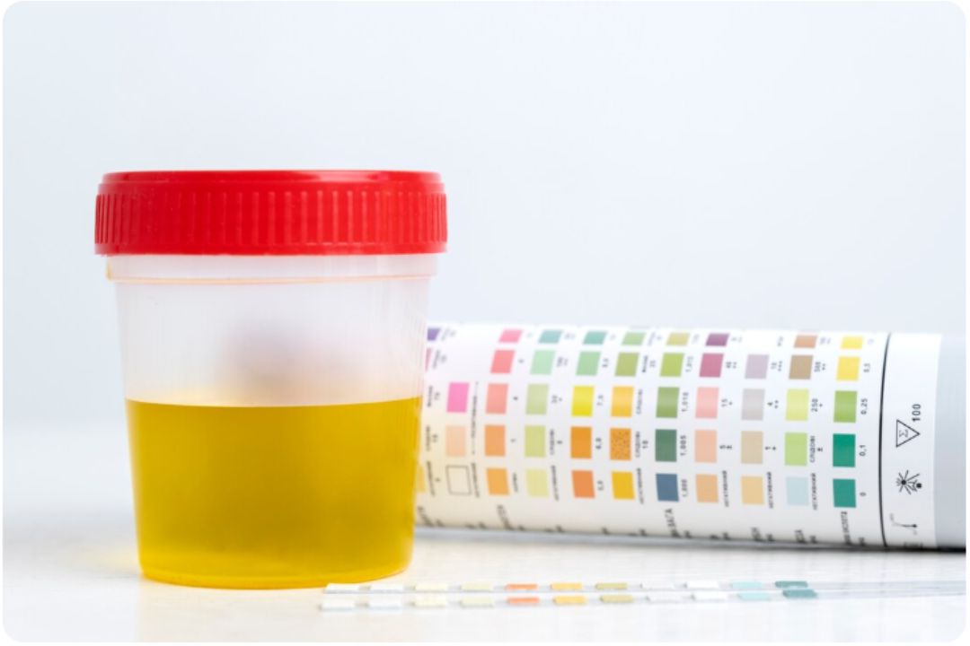 Urine Spot Potassium Test vs Serum Potassium Differences, Accuracy and Uses