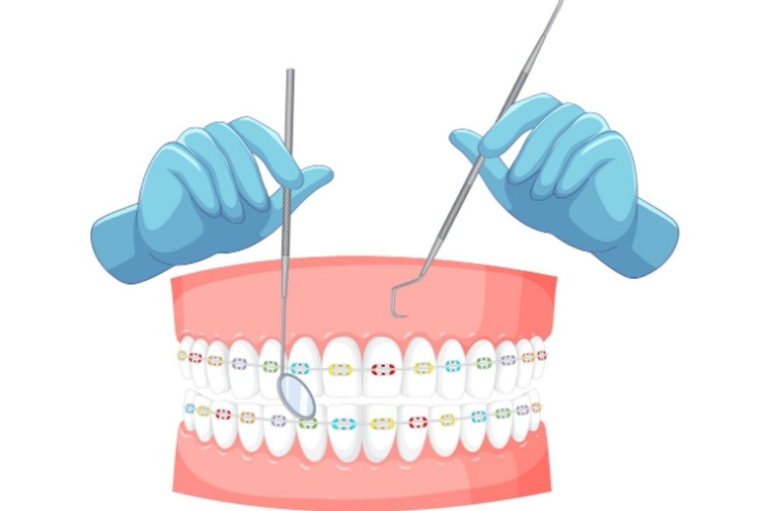 Dental Braces Cost in India: Complete Price Guide and Why Choose Diagnopein