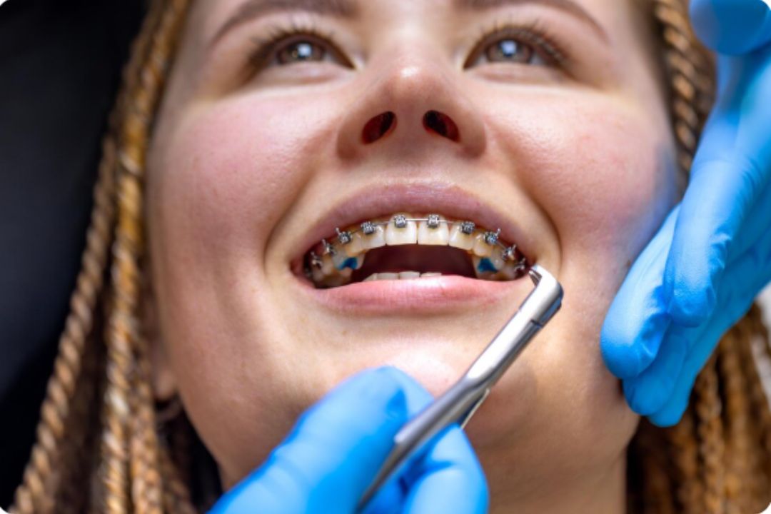 Do Braces Change Your Face Shape? Myths vs. Facts | Diagnopein