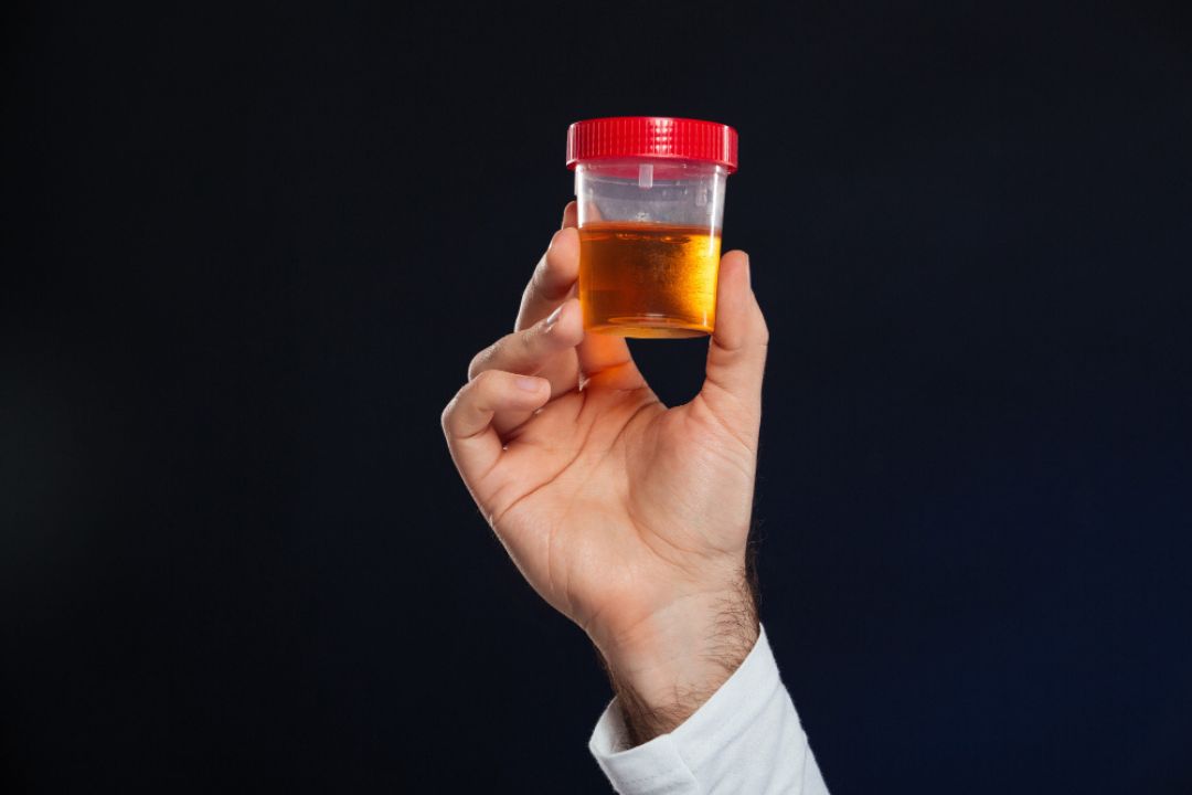 24-Hour Urine Cortisol Test: Complete Guide to Purpose, Procedure & Results