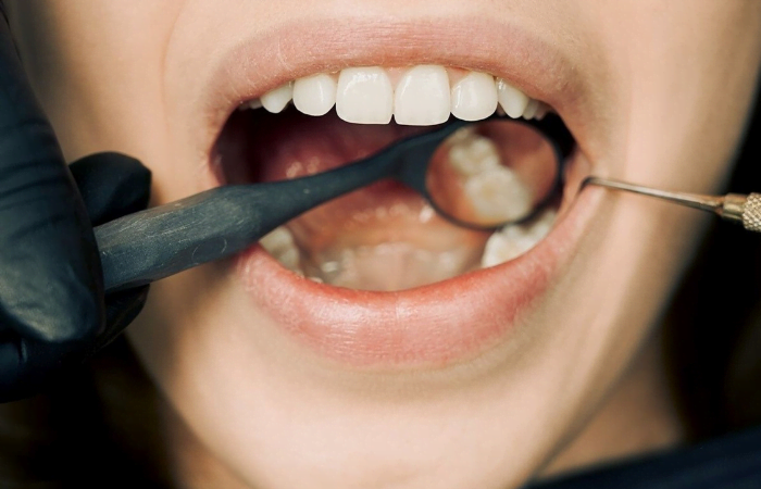 Wisdom Teeth Removal & Decay: Signs, Risks & Prevention | Diagnopein